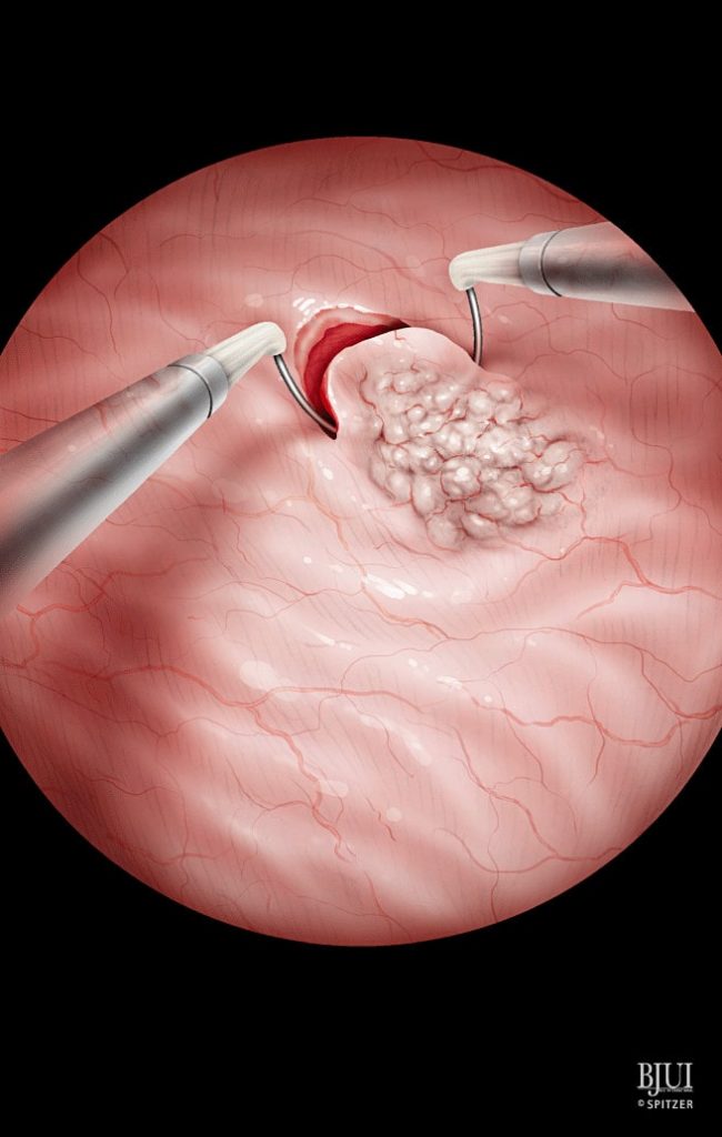 Transurethral Resection Of Bladder Tumour Sydney TURBT Procedure